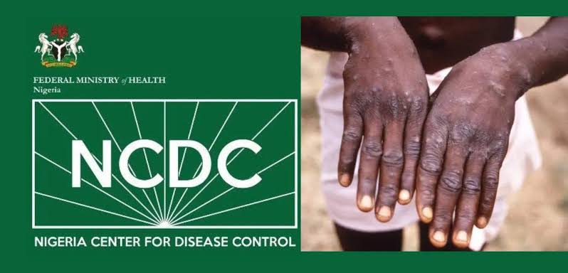 NCDC Says No Treatment For Monkeypox