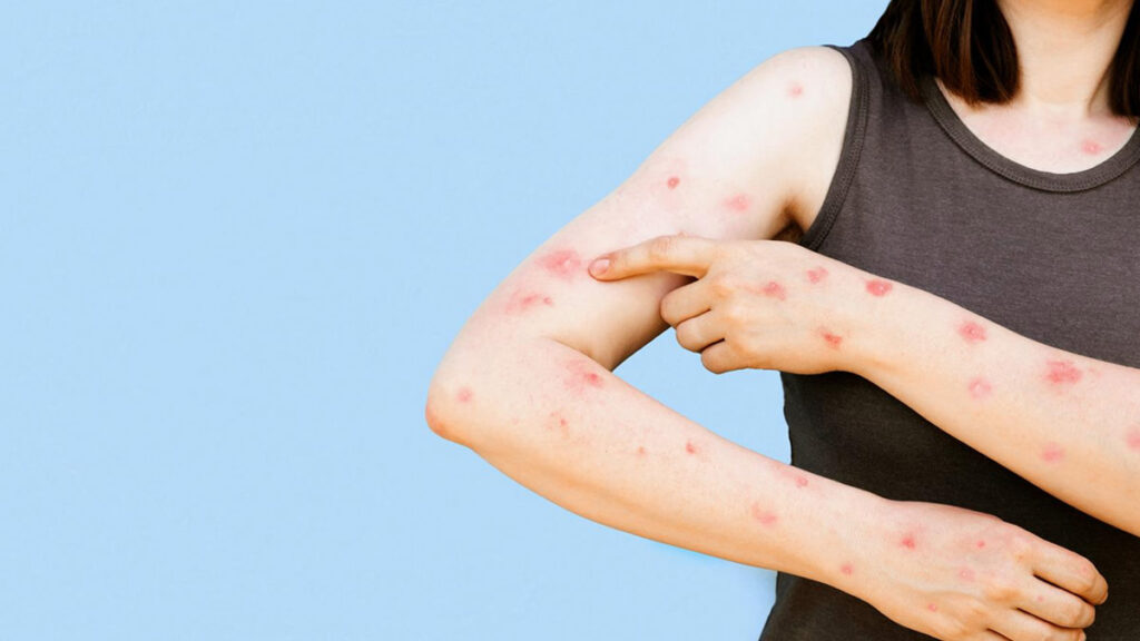 Study Suggests Monkeypox Spreads Four Days Before Symptoms Appear